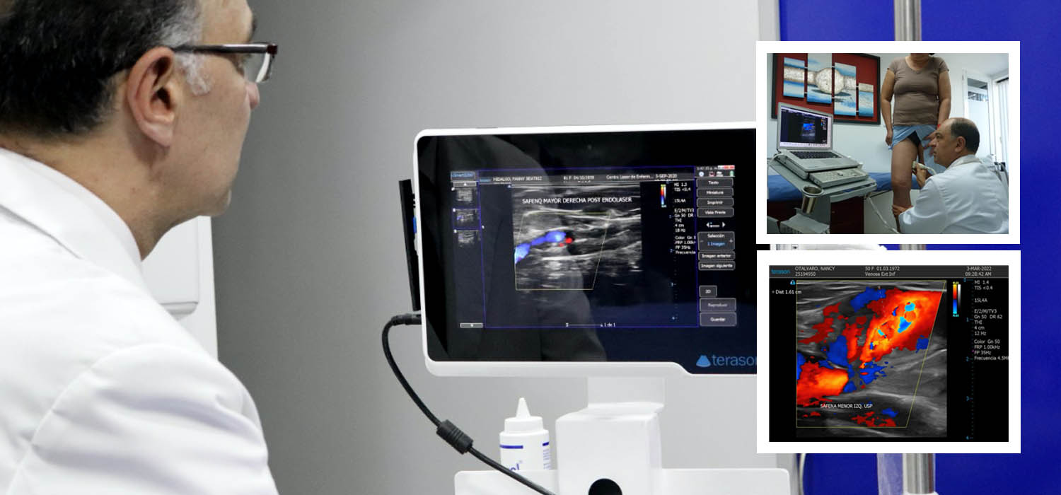 Tratamiento para várices sin cirugía, Varices Venas Varices Venas ...